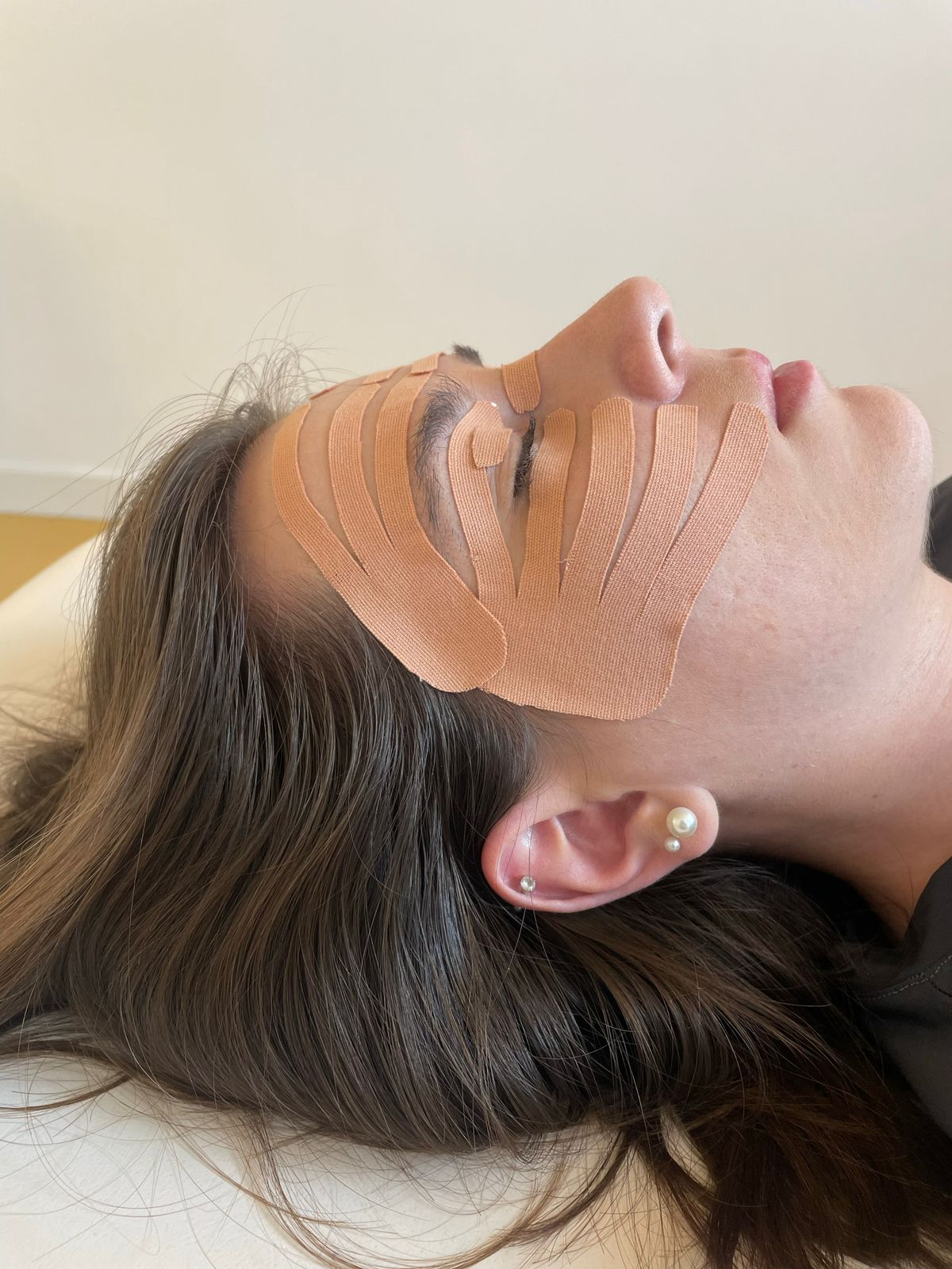 Taping no pós operatório de rinoplastia - Clínica Fortius